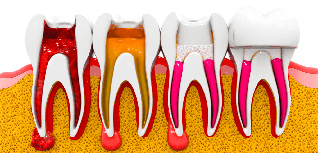 Endodontie - Wurzelbehandlung | City Dental Clinic